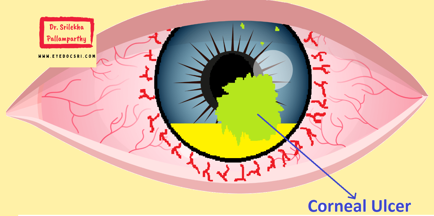 Microbial corneal ulcer – Dr. Srilekha Pallamparthy